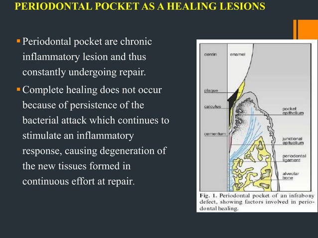 PERIODONTAL POCKET.pptx