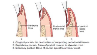 PERIODONTAL_POCKET pathogenesis and management | PPTX