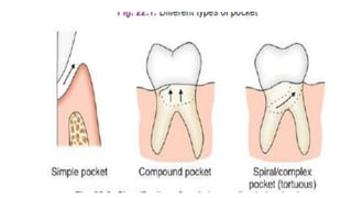 PERIODONTAL_POCKET pathogenesis and management | PPTX