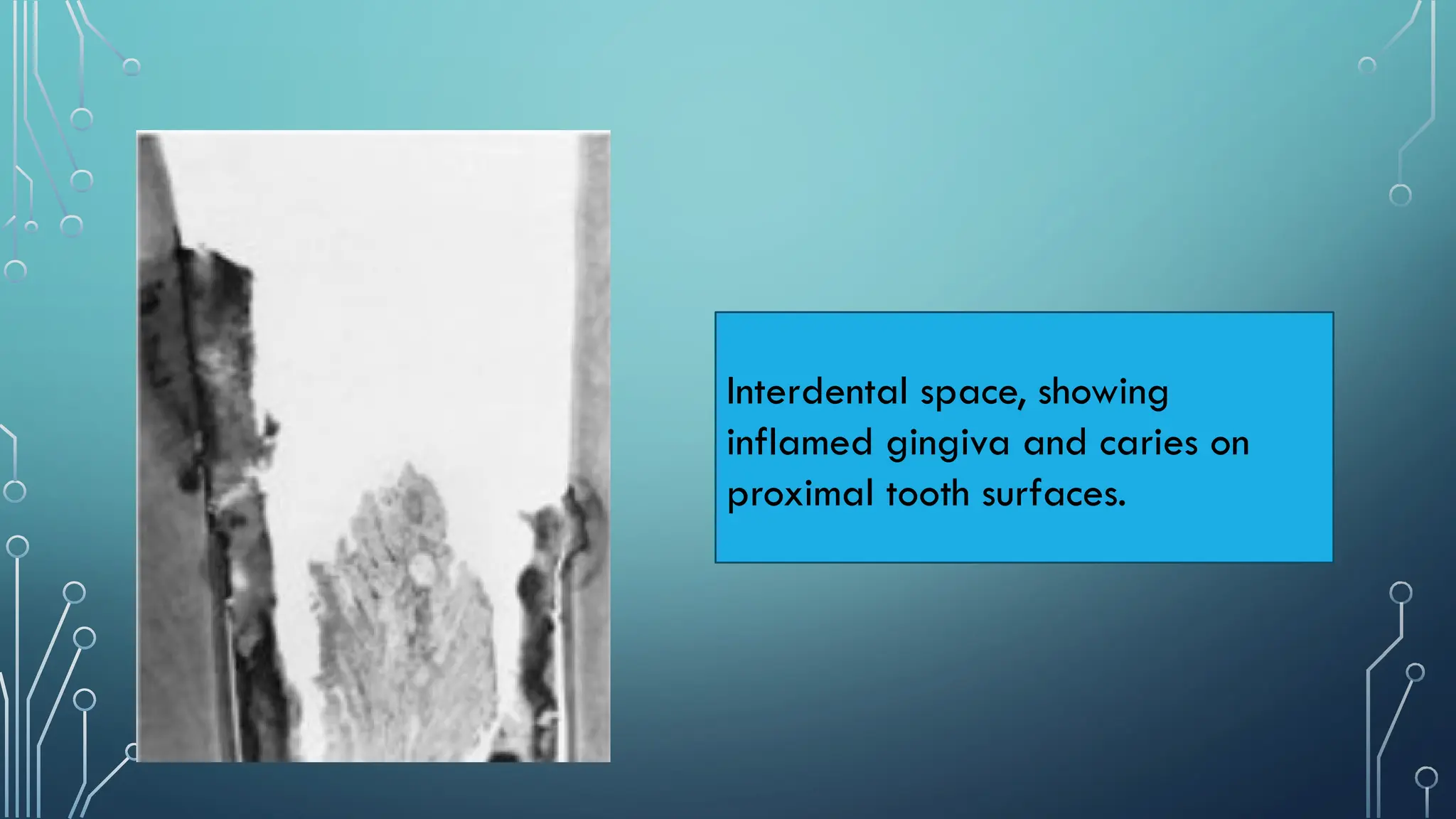 PERIODONTAL POCKET.pptx................. | PPTX