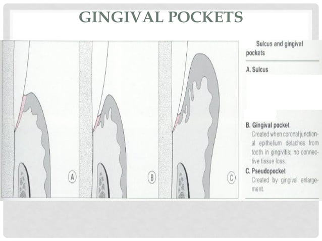 periodontal pocket AND ITS EFFECTS ON DENTITION | PPTX