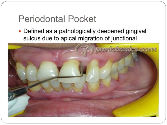 Periodontal pocket activity | PPT
