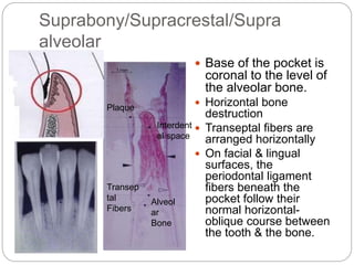 Periodontal pocket activity | PPTX