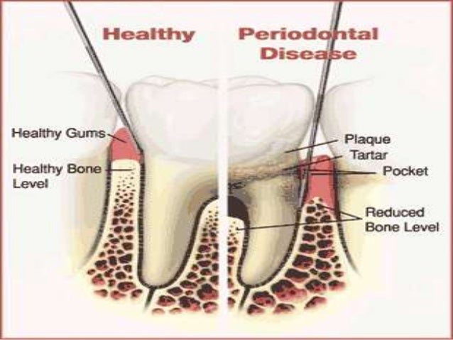 Periodontal pocket activity
