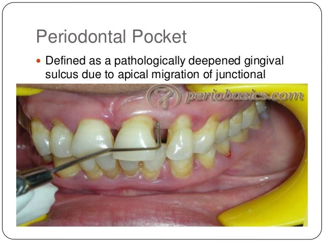Periodontal pocket activity