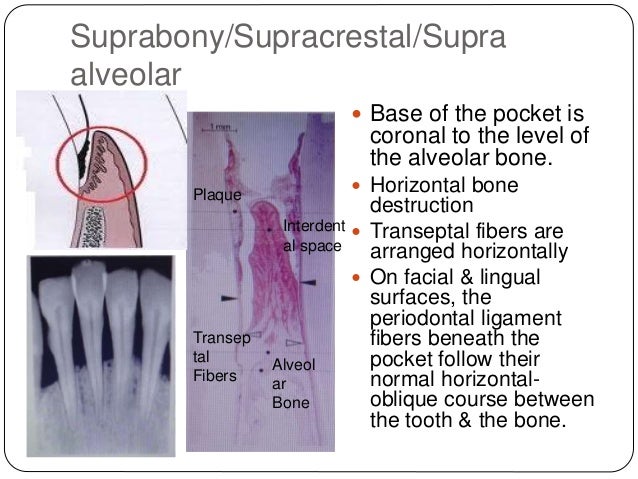 Periodontal pocket activity