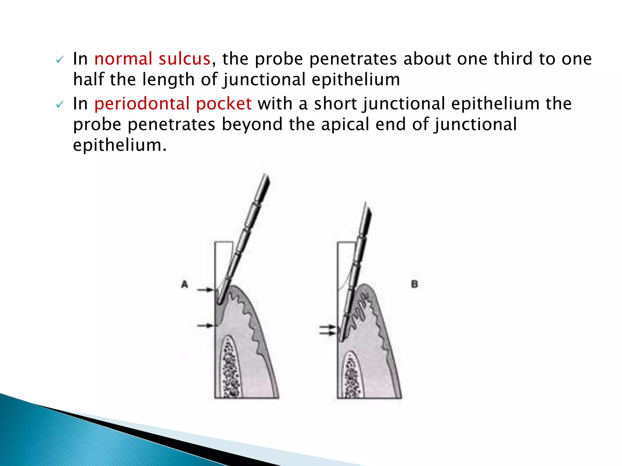 Periodontal Pocket | PPTX