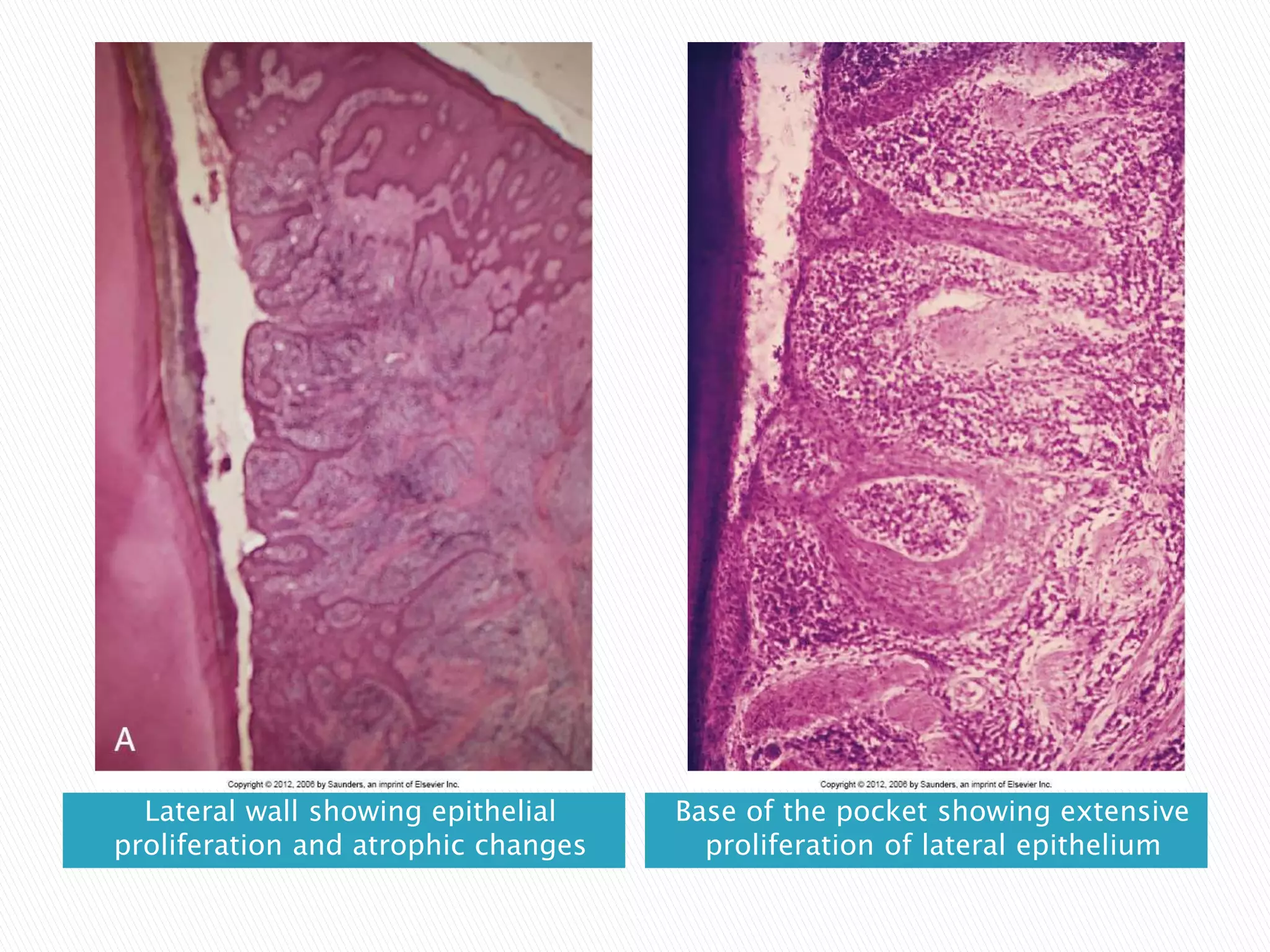 Periodontal Pocket | PPTX