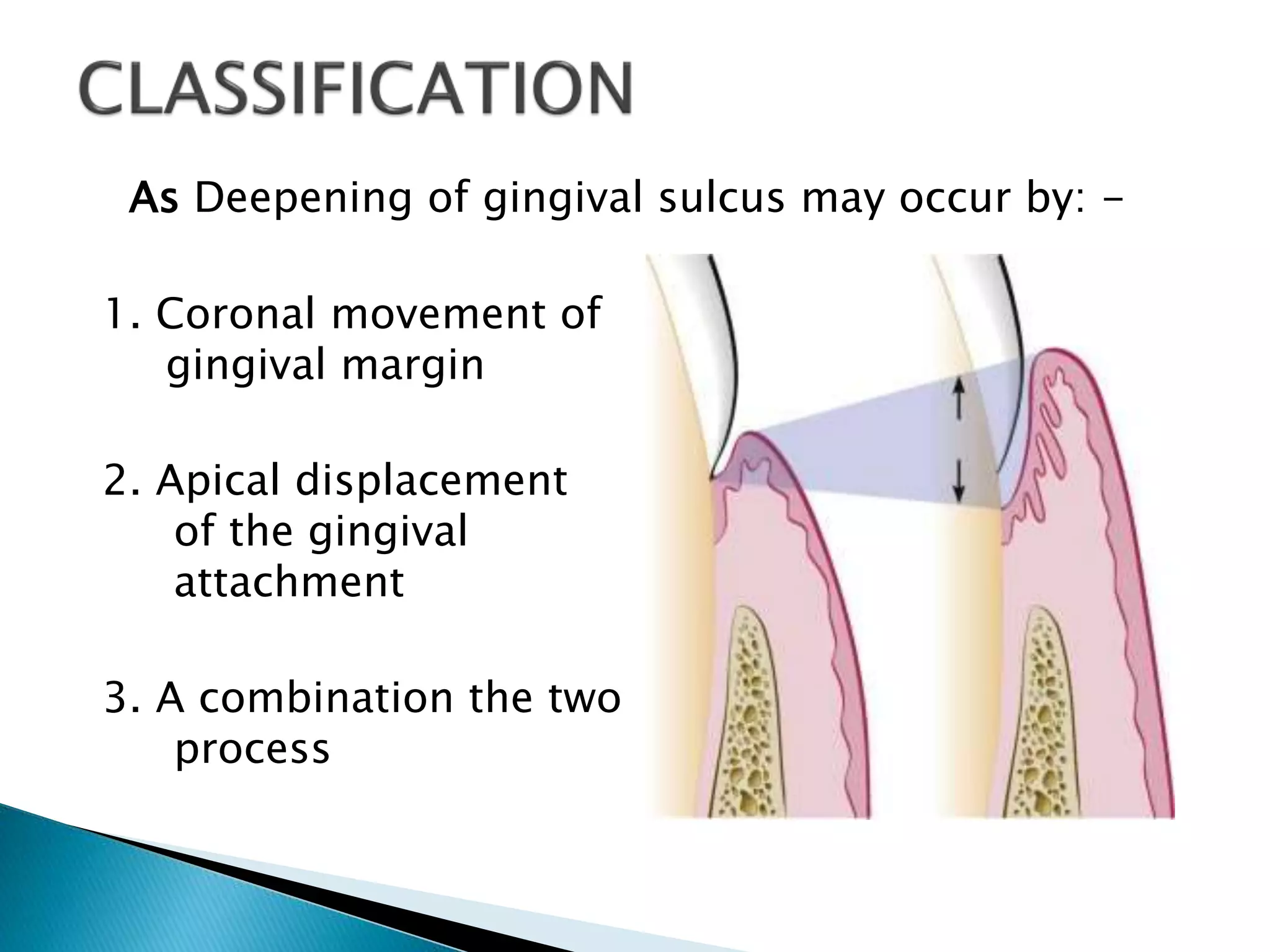 Periodontal Pocket | PPTX