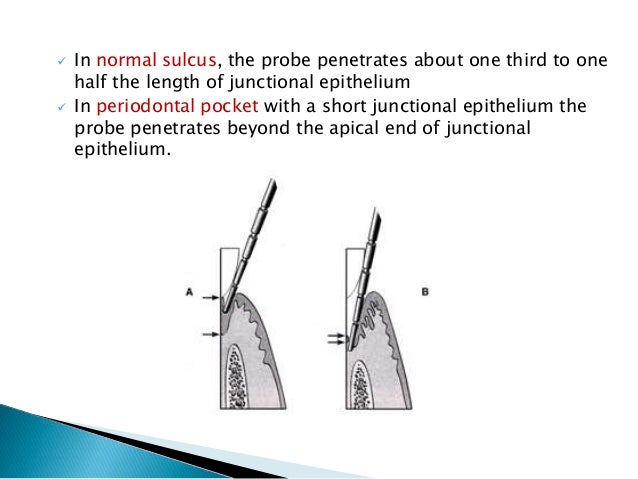 Periodontal Pocket