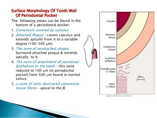 Periodontal Pocket