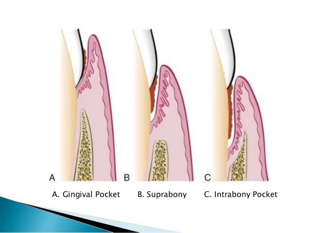 Periodontal Pocket