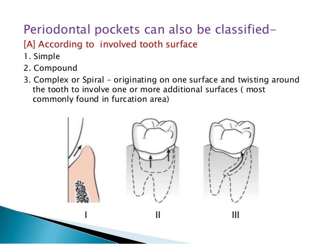 Periodontal Pocket