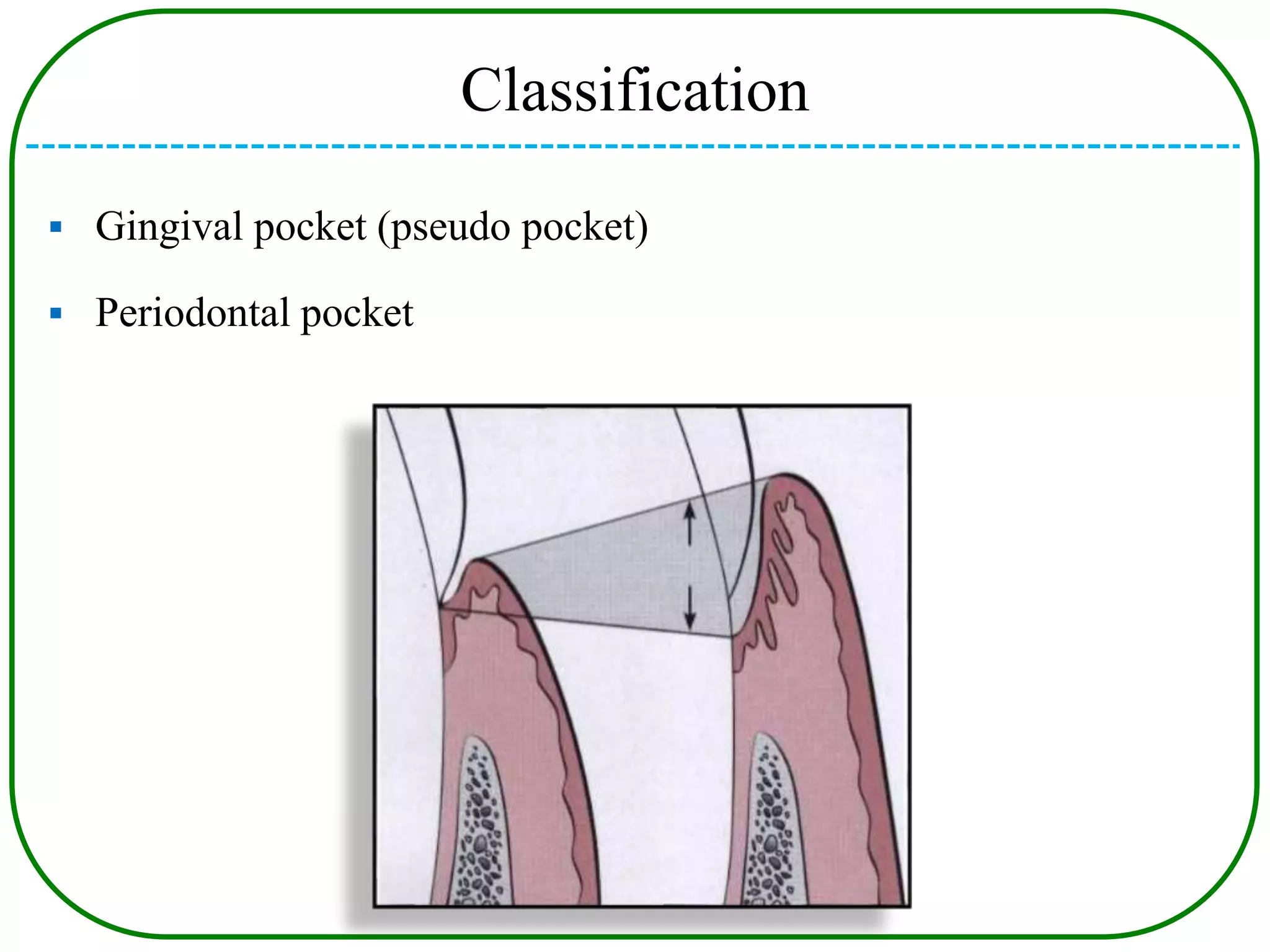 Periodontal pockets | PPTX