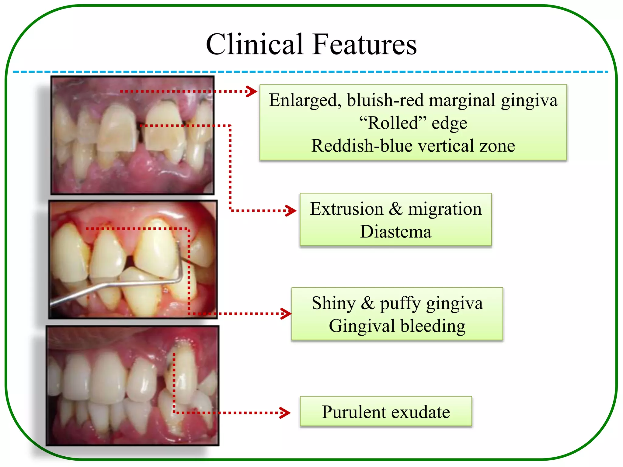 Periodontal pockets | PPTX