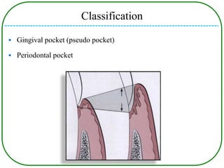 Periodontal pockets | PPTX