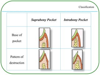 Periodontal pockets | PPT