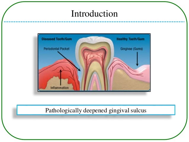 Periodontal pockets