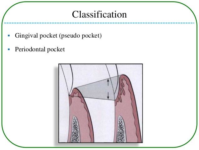 Periodontal pockets