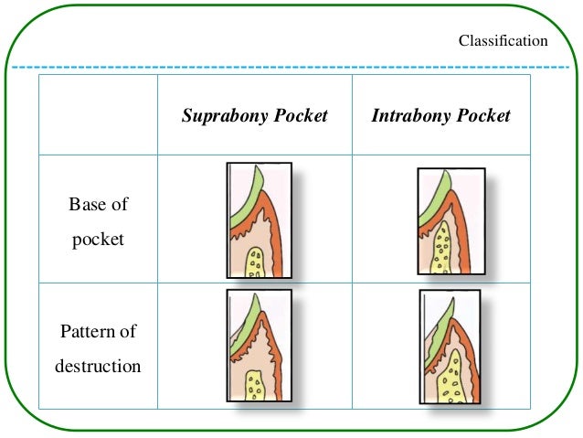 Periodontal pockets