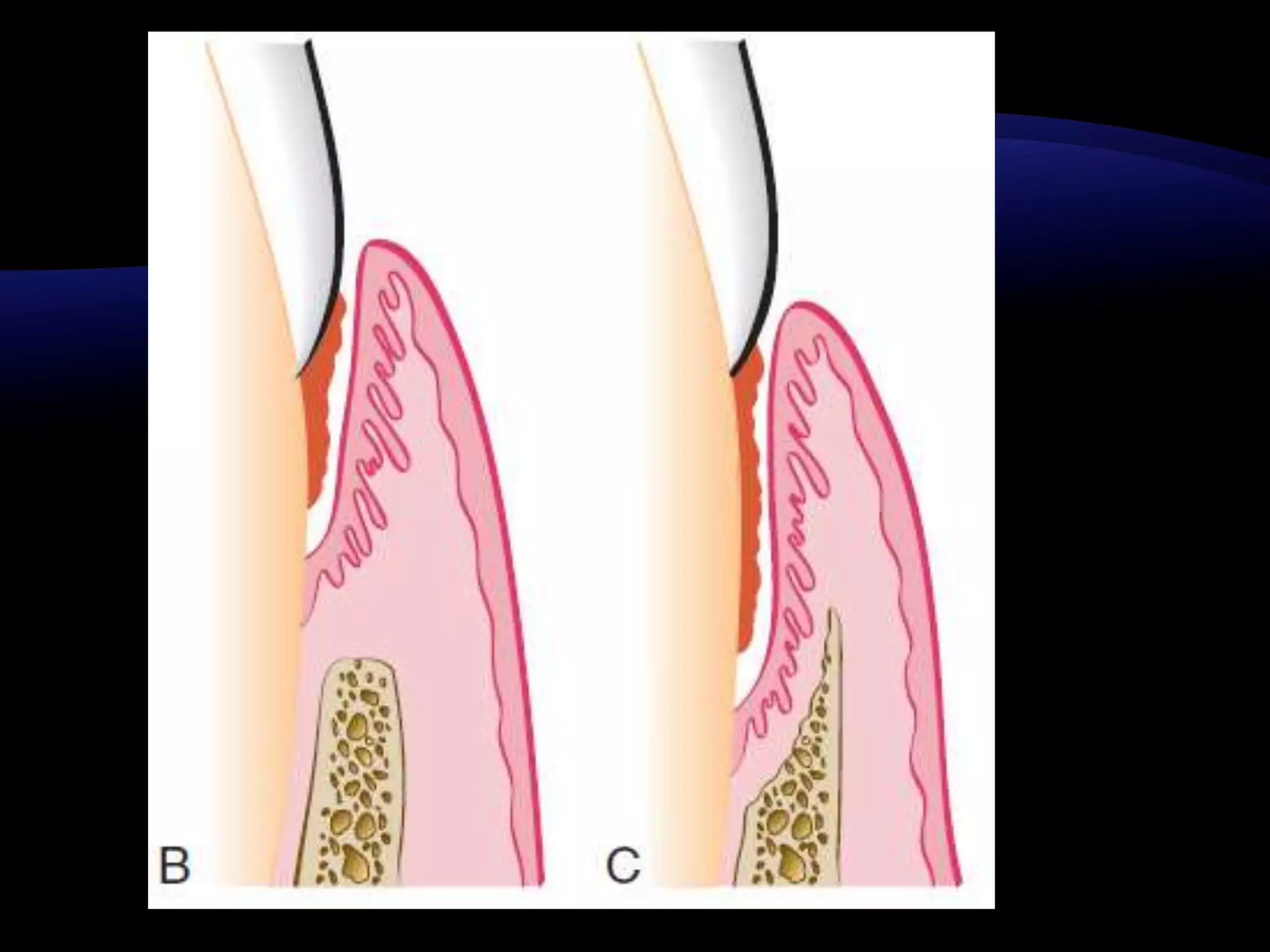 Periodontal pockets.pptx