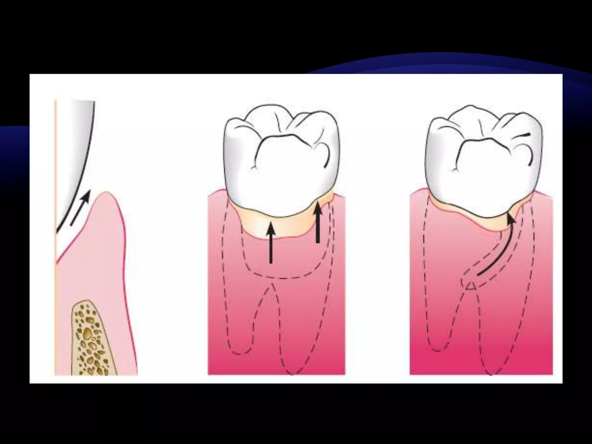 Periodontal pockets.pptx