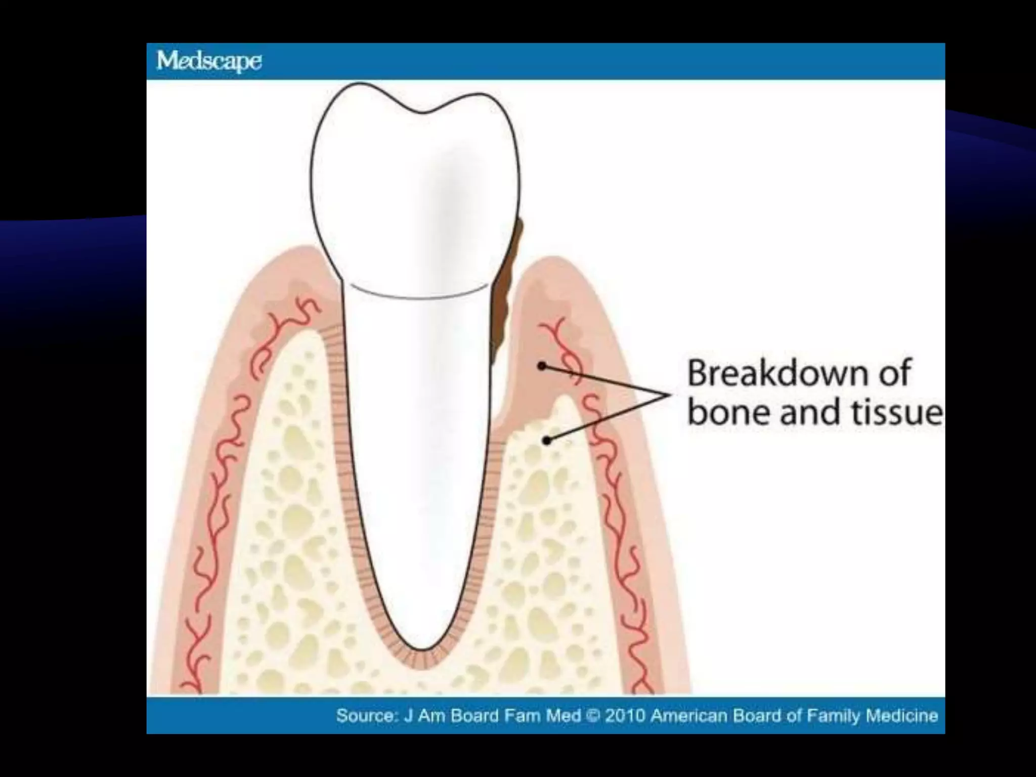 Periodontal pockets.pptx
