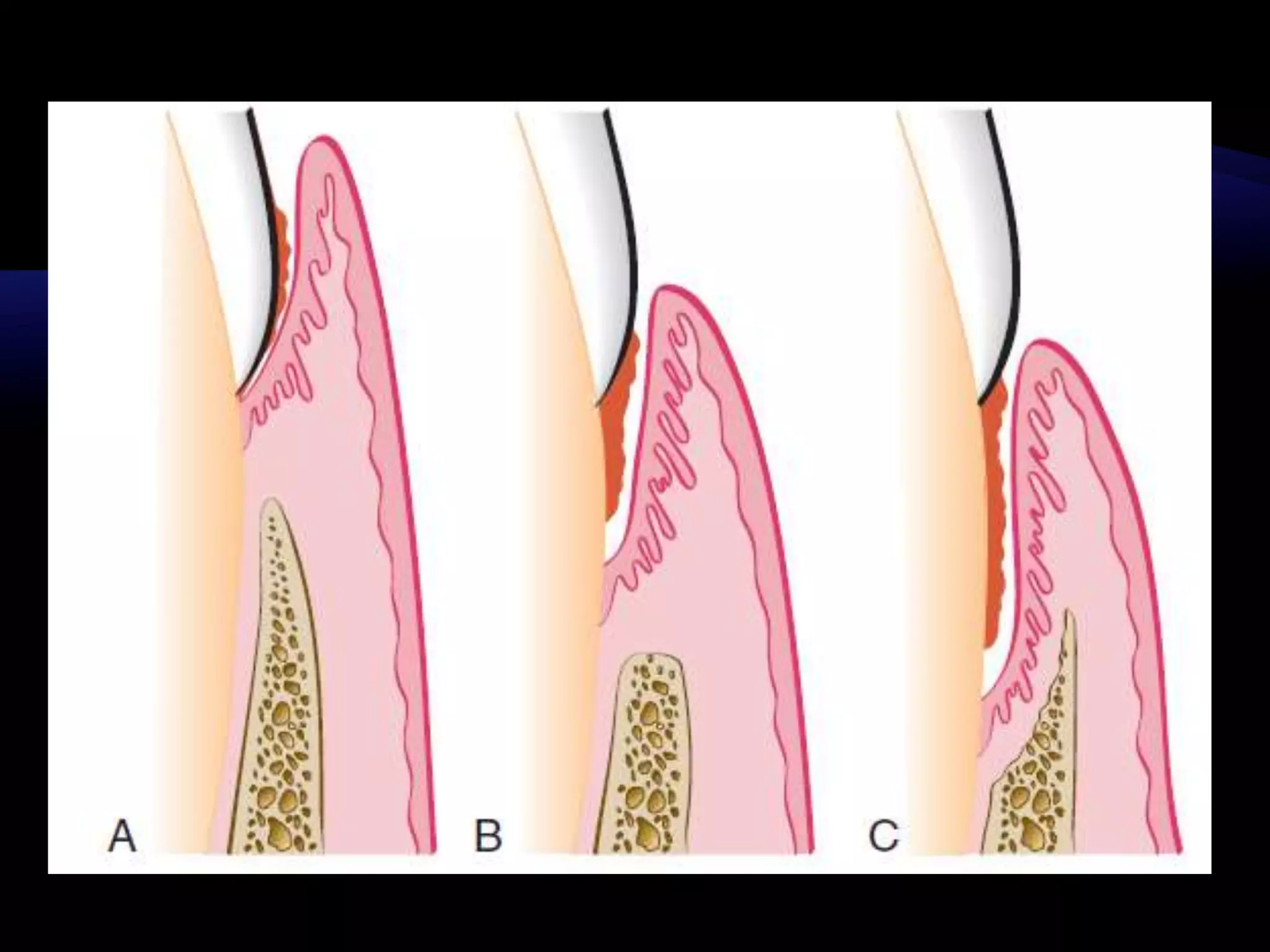 Periodontal pockets.pptx