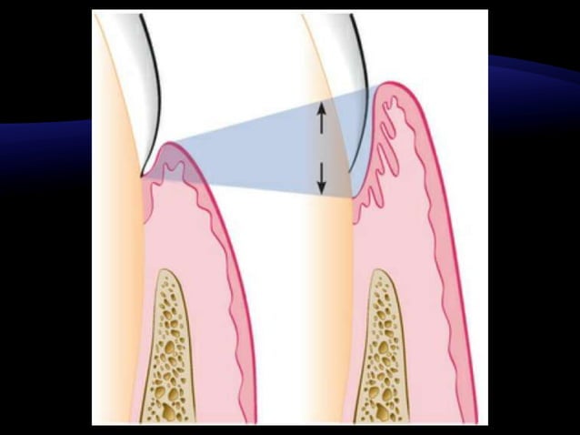 Periodontal pockets.pptx