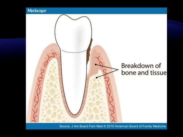 Periodontal pockets.pptx
