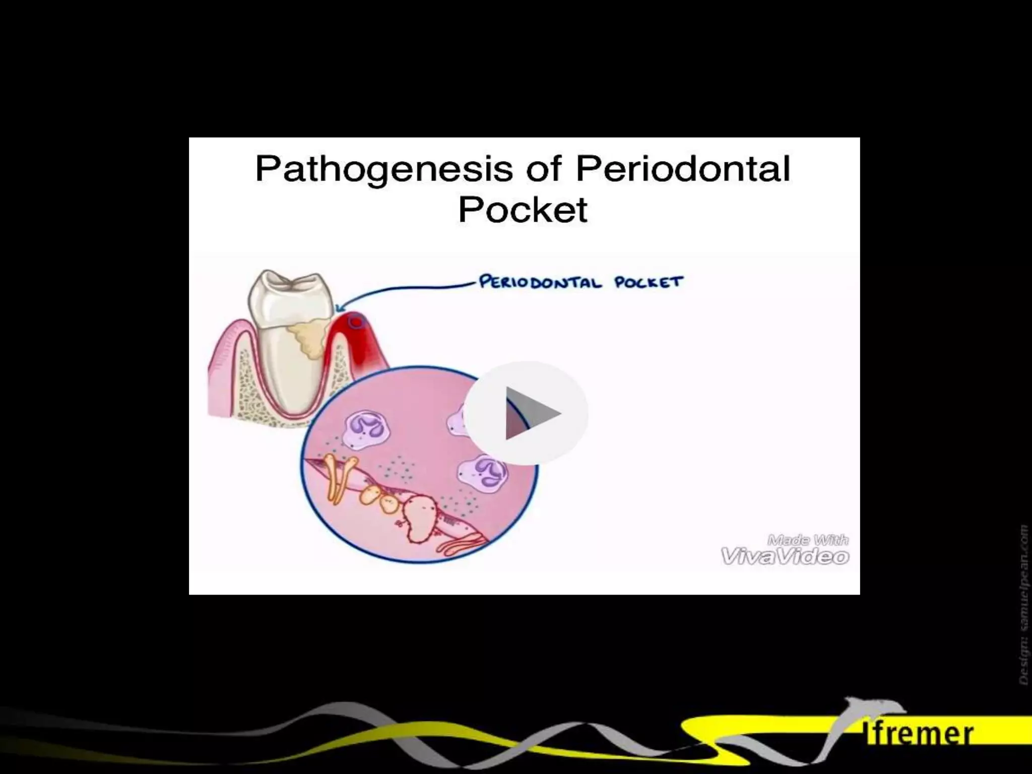 Periodontal pockets & it's pathogenesis | PPTX
