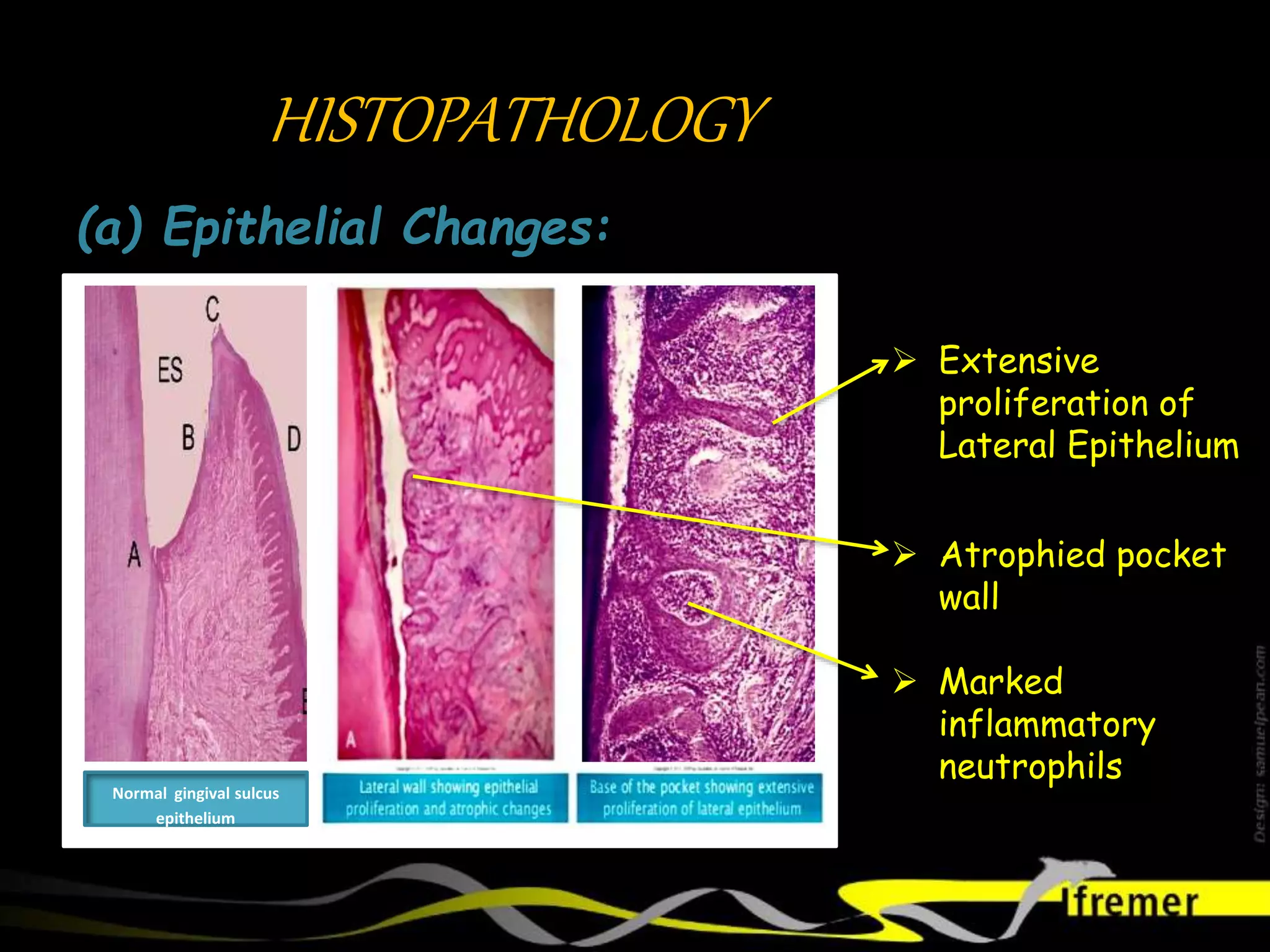 Periodontal pockets & it's pathogenesis | PPTX