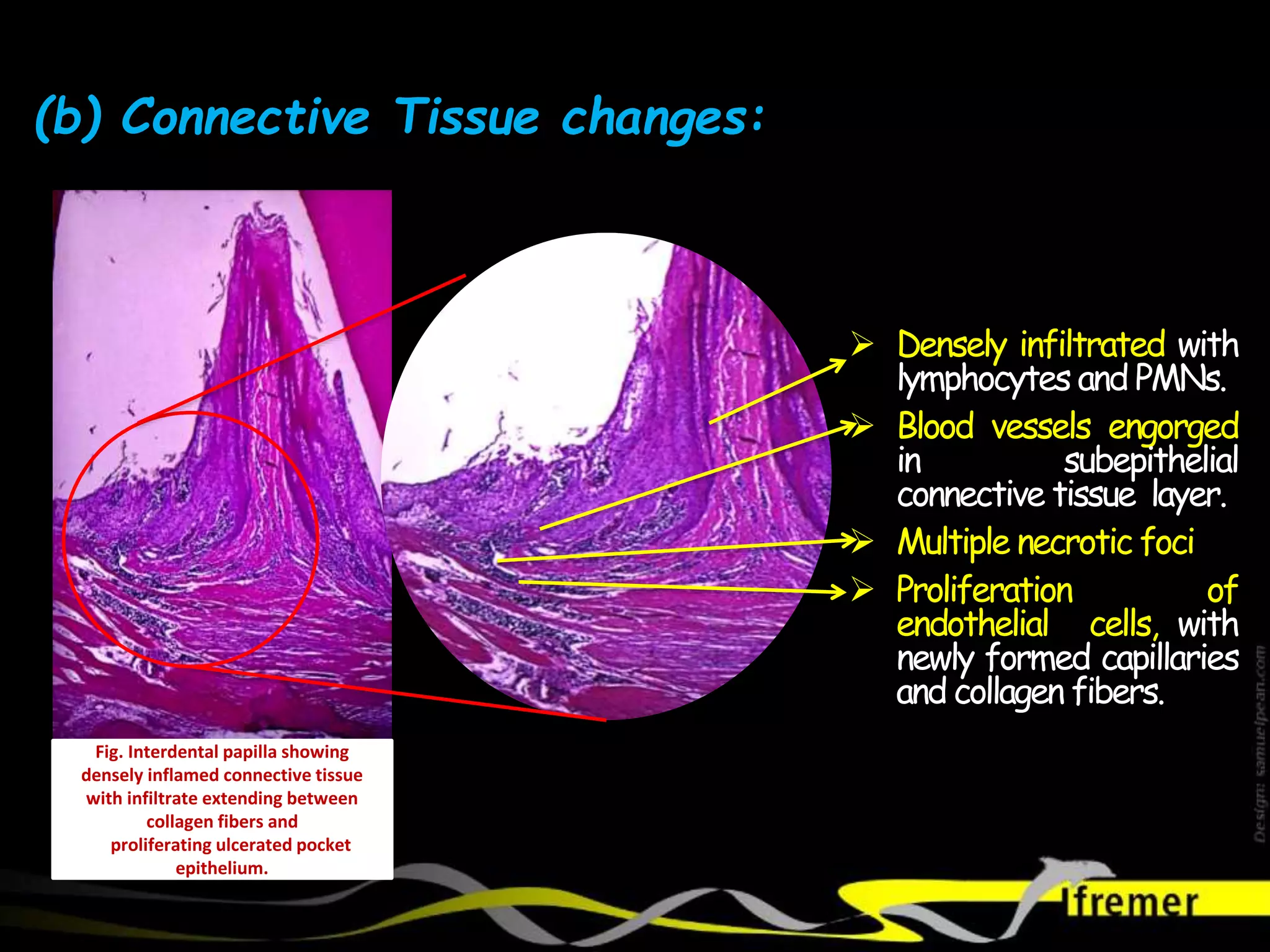 Periodontal pockets & it's pathogenesis | PPTX