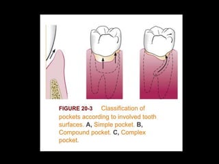 Periodontal pockets & it's pathogenesis | PPTX