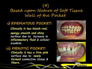 Periodontal pockets & it's pathogenesis | PPTX