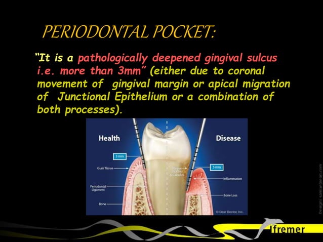 Periodontal pockets & it's pathogenesis | PPTX
