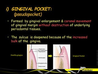 Periodontal pockets & it's pathogenesis | PPTX