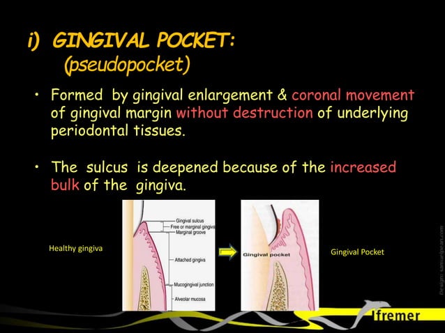 Periodontal pockets & it's pathogenesis | PPTX