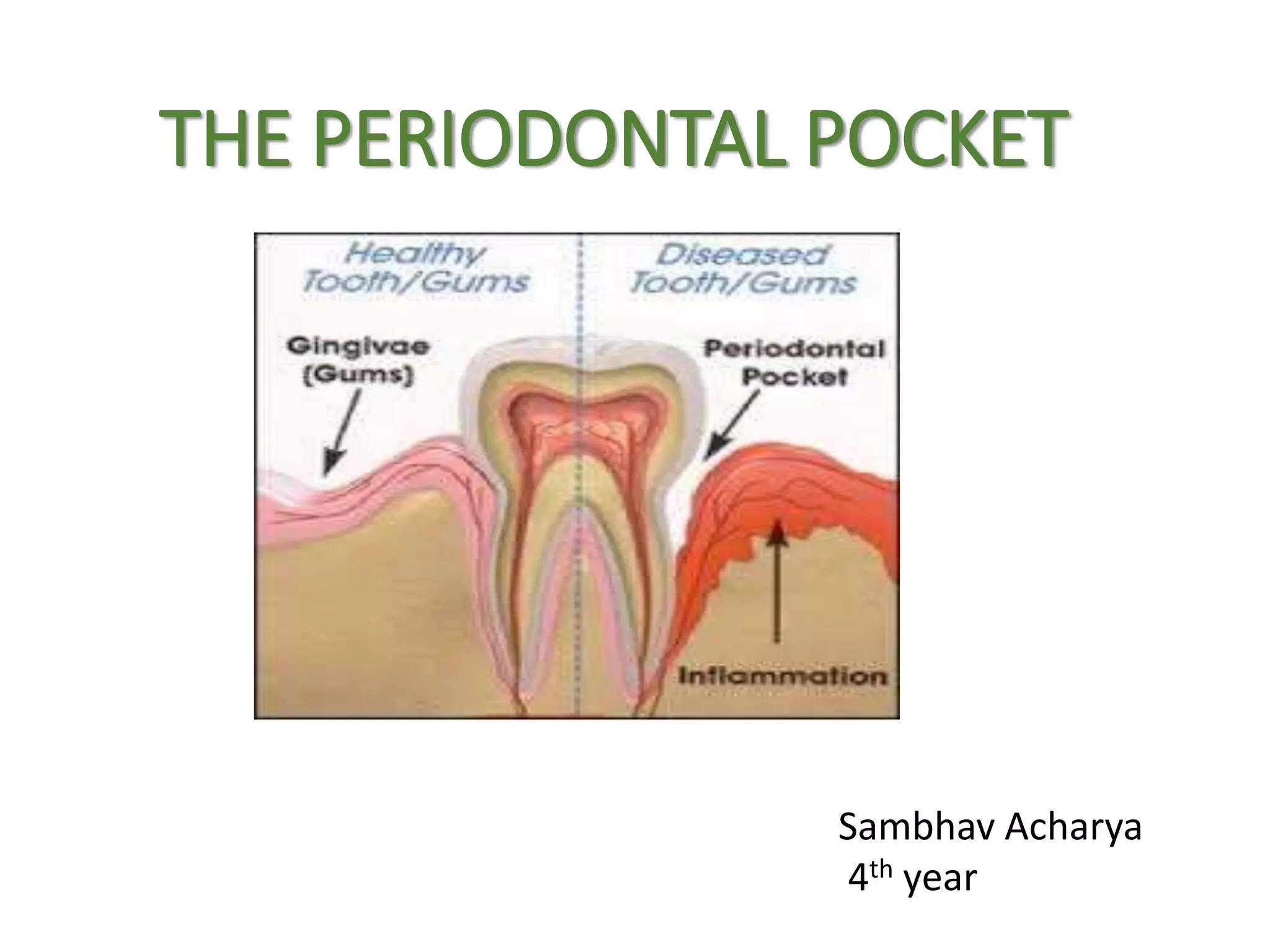 The Periodontal Pocket | PPTX