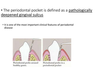 The Periodontal Pocket | PPTX