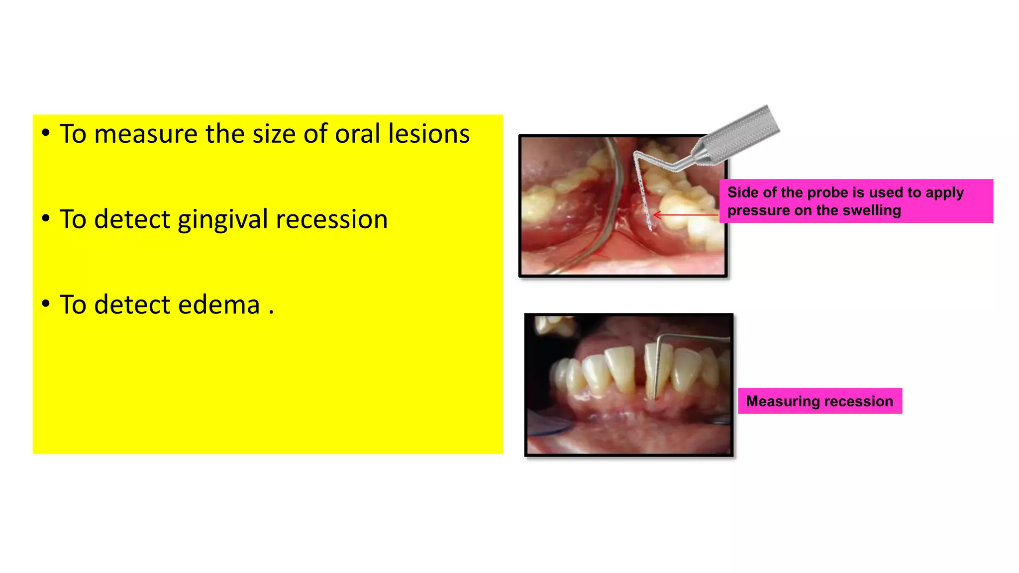 Periodontal probe | PPTX