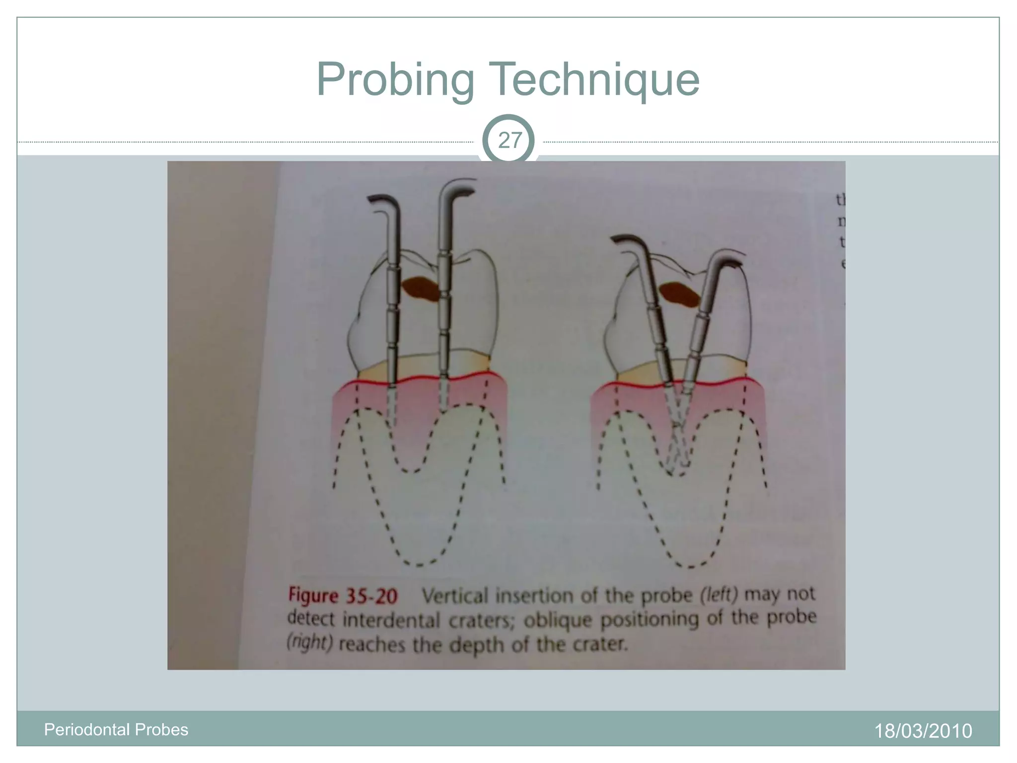 Periodontal probes | PPT
