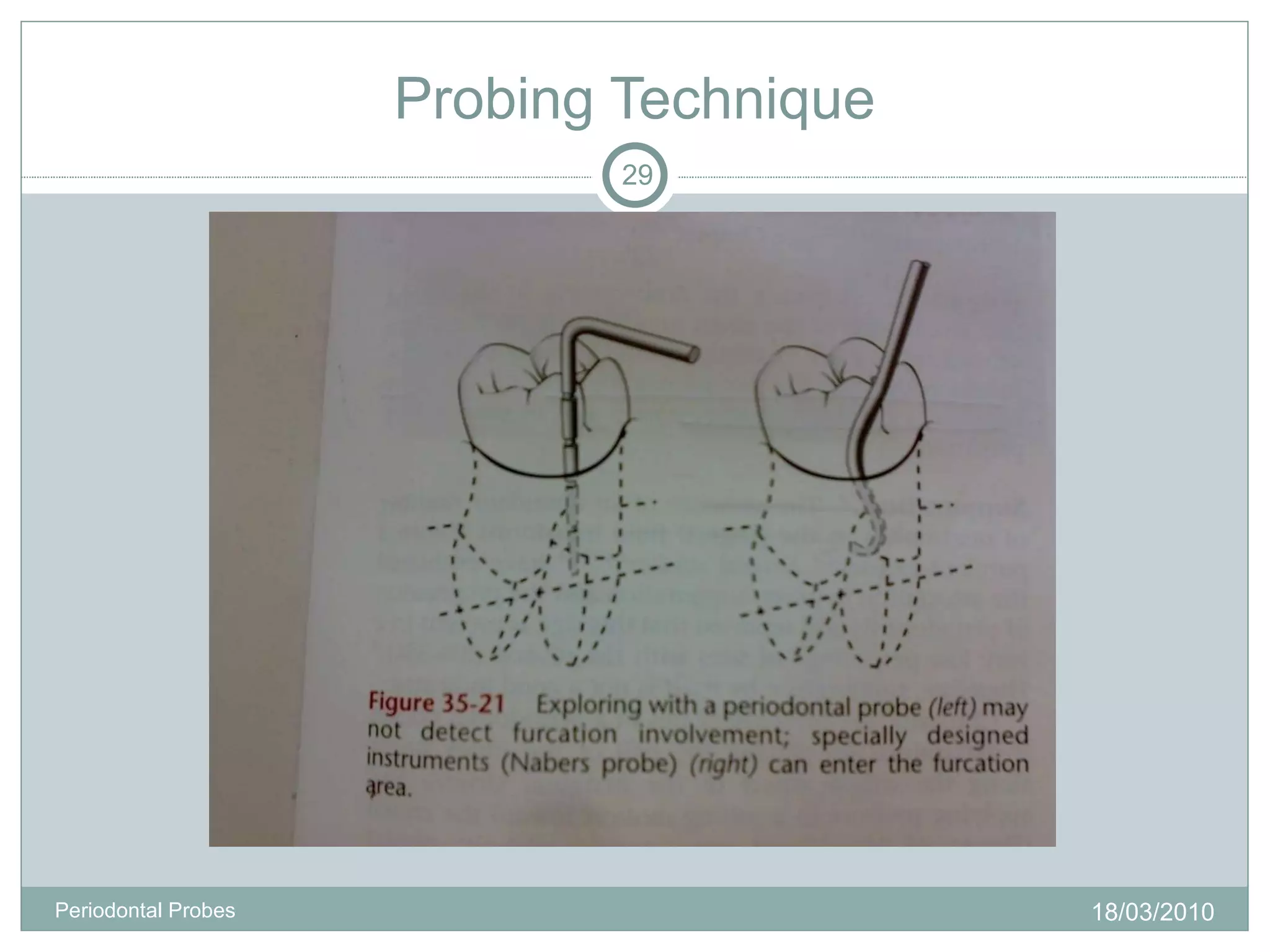 Periodontal probes | PPT