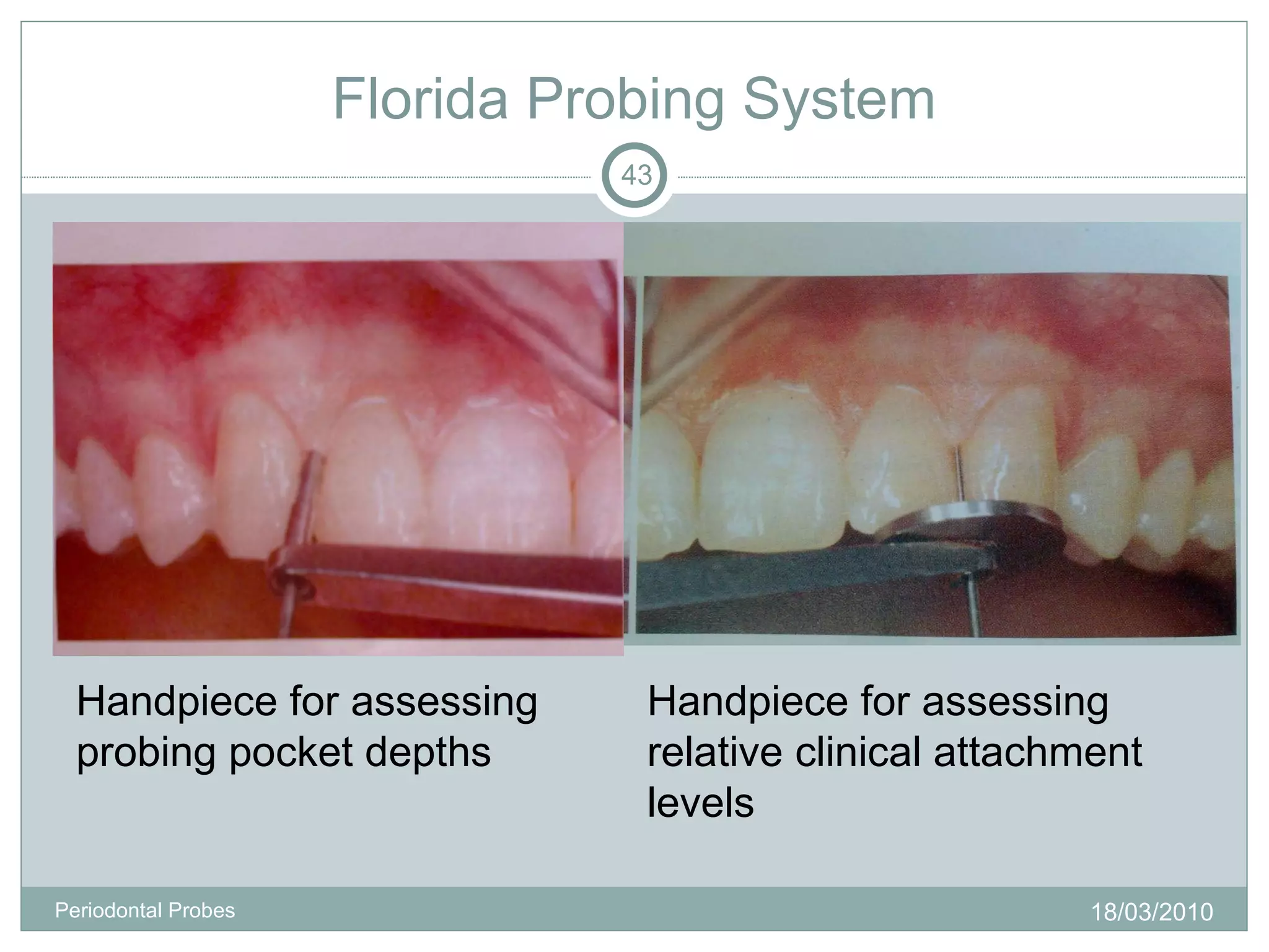 Periodontal probes | PPT