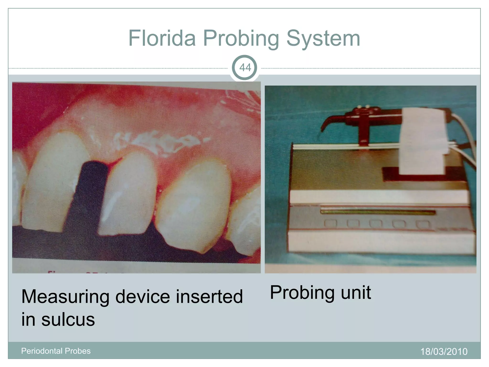Periodontal probes | PPT