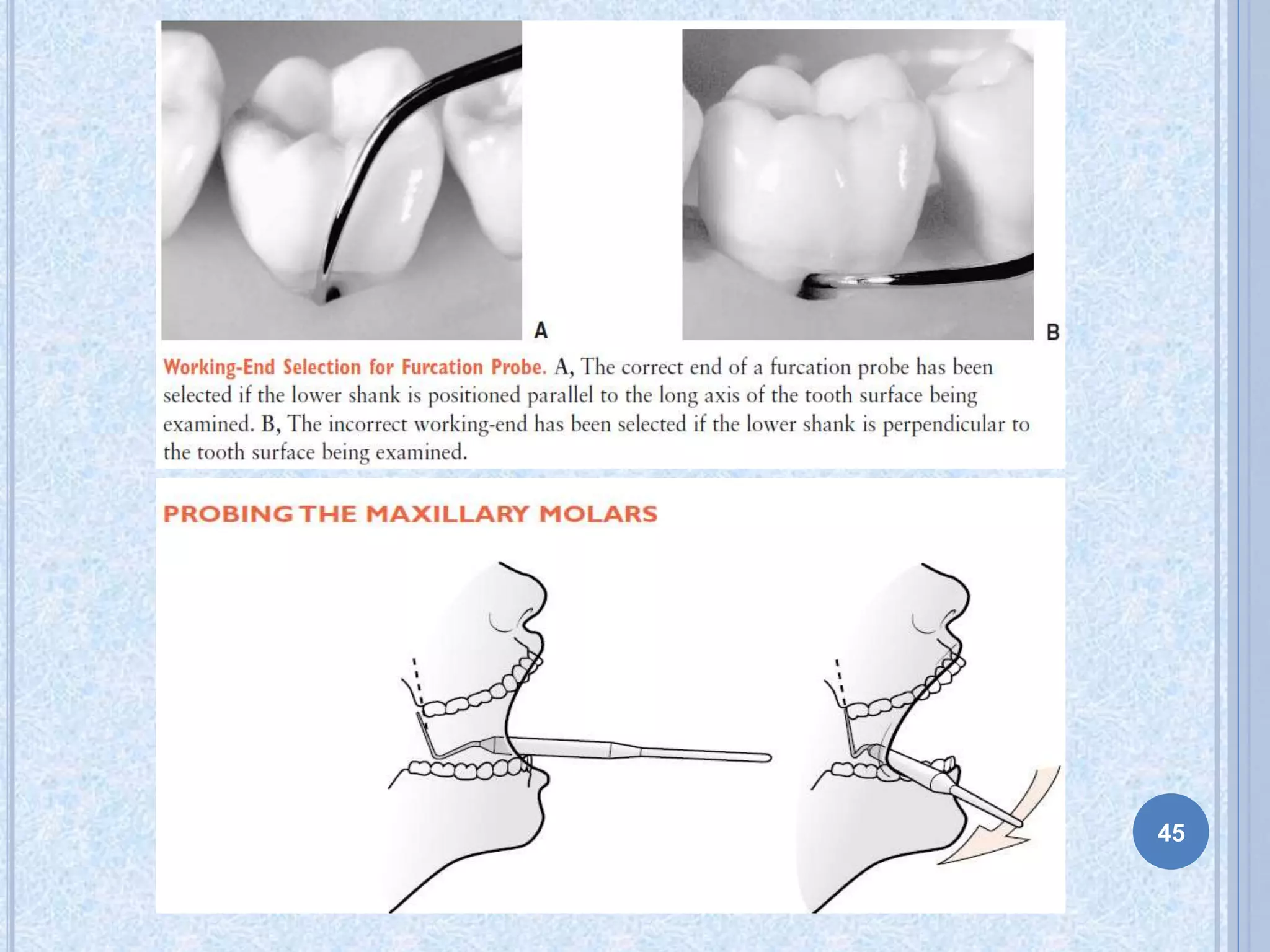 Periodontal probes | PPTX