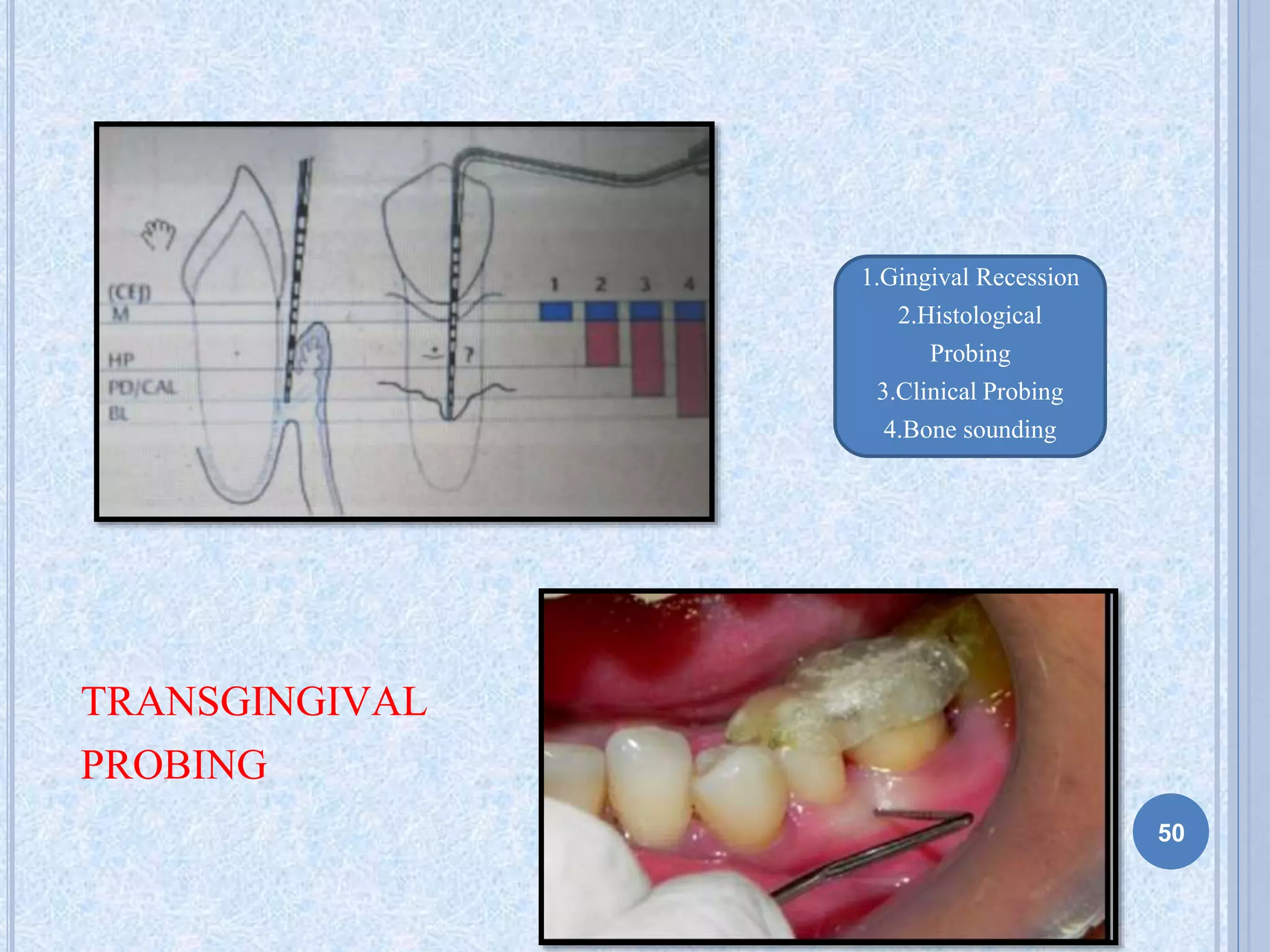 Periodontal probes | PPTX