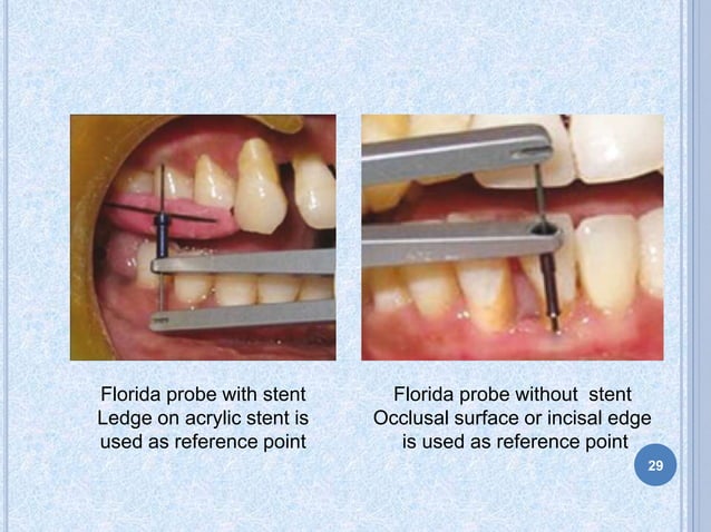 Periodontal probes | PPTX | Oral care | Personal Care