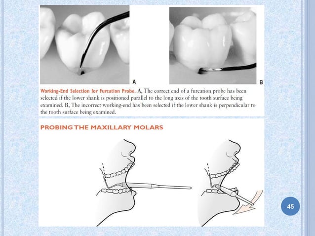 Periodontal probes | PPTX | Oral care | Personal Care