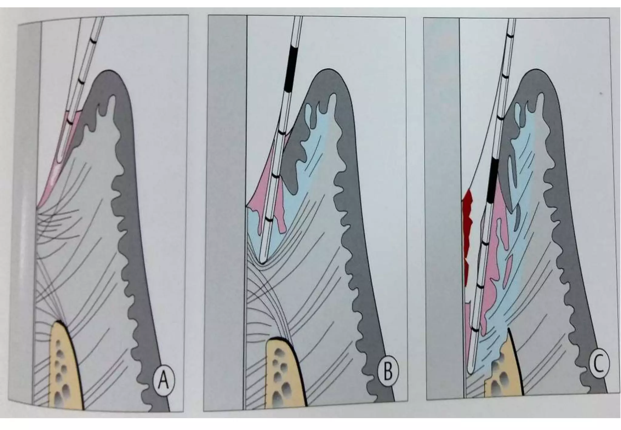 Periodontal probes | PPTX